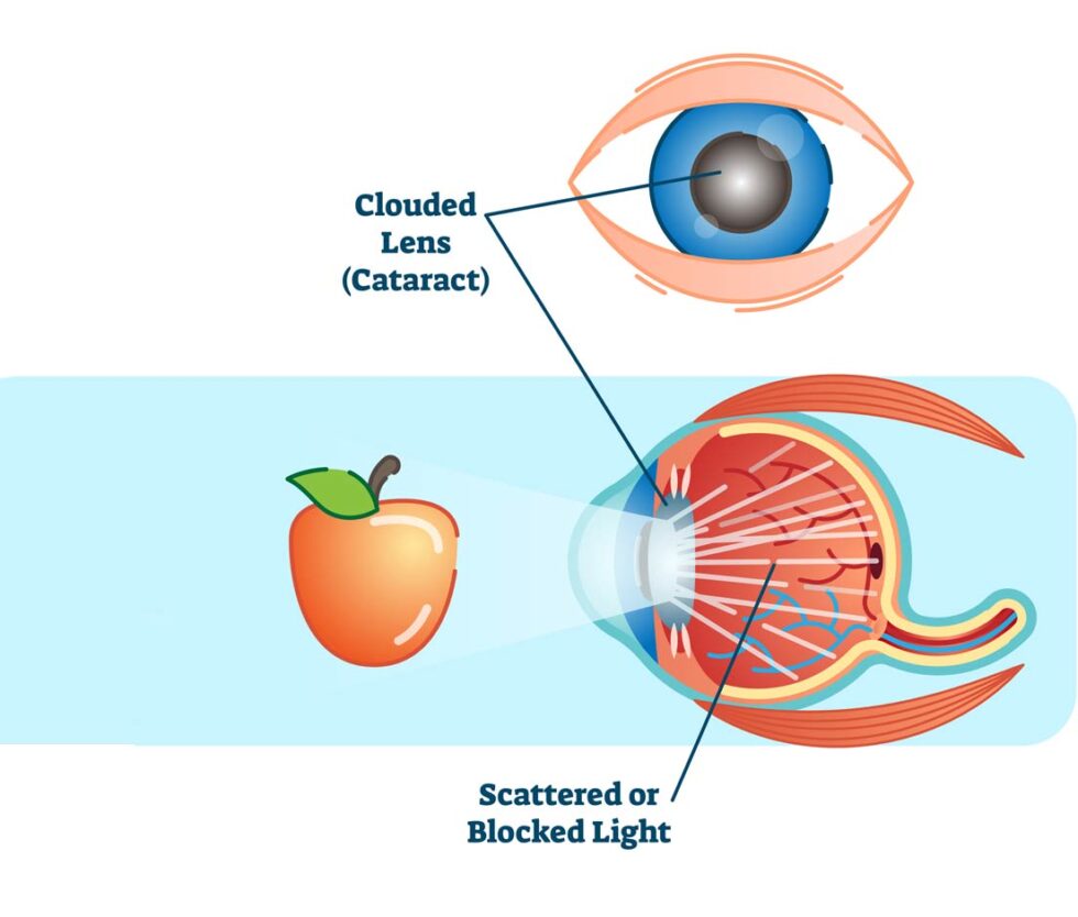 Cataract Diagnosis & Co-Management Jacksonville, FL - Baymeadows Vision ...